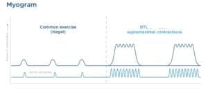 Funktionsweise EMP Chair – Beckenboden Trainer – IPL Hamburg